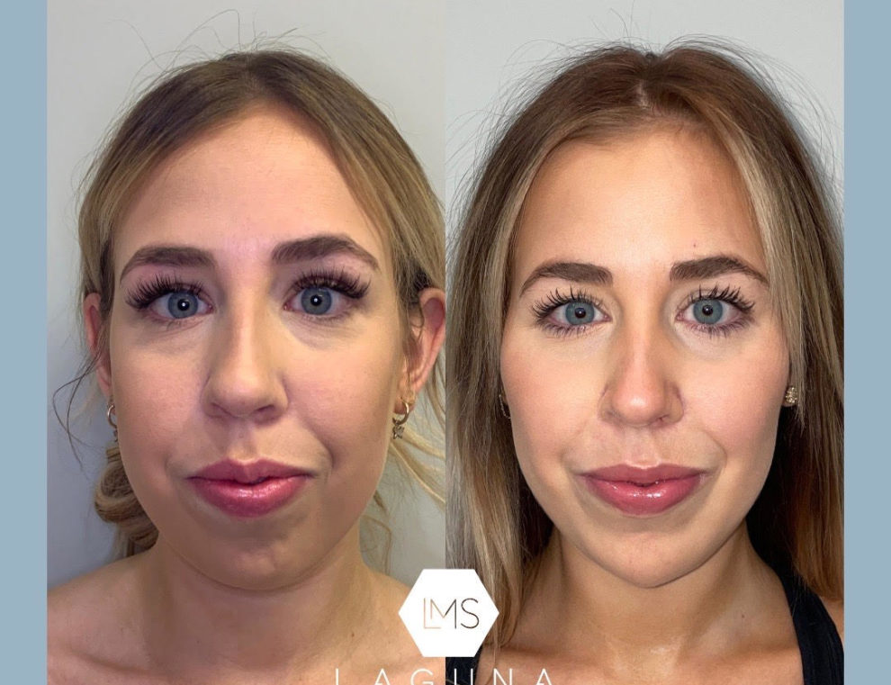 Lipolean Injections - Botox - Juvederm - Restylane | Laguna Med Spa