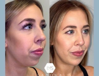 Lipolean Injections - Botox - Juvederm - Restylane | Laguna Med Spa