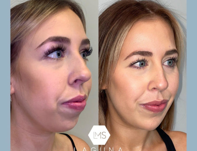 Lipolean Injections - Botox - Juvederm - Restylane | Laguna Med Spa