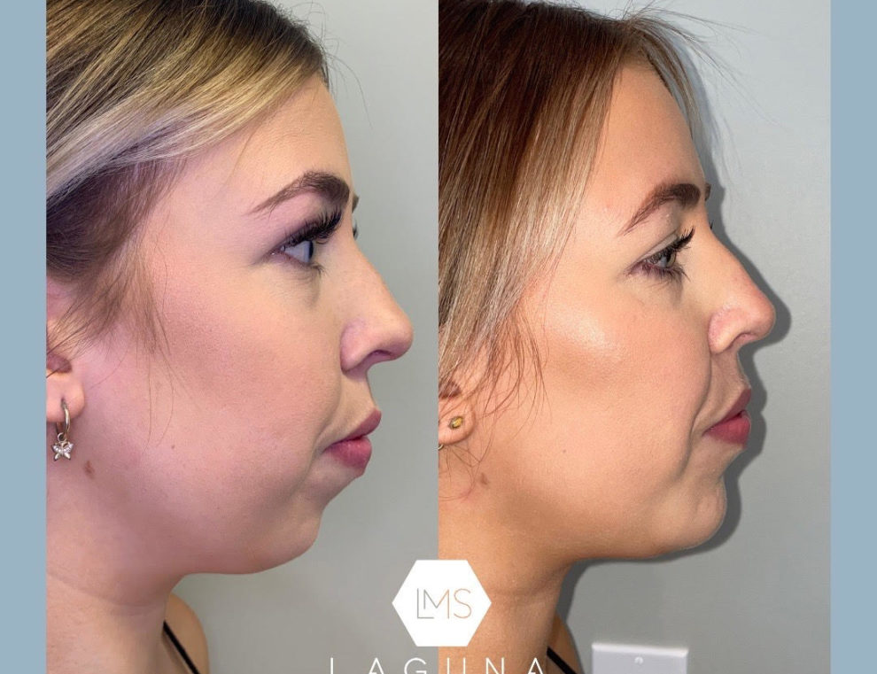 Lipolean Injections - Botox - Juvederm - Restylane | Laguna Med Spa