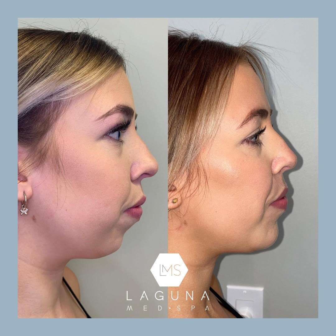 Lipolean Injections - Botox - Juvederm - Restylane | Laguna Med Spa