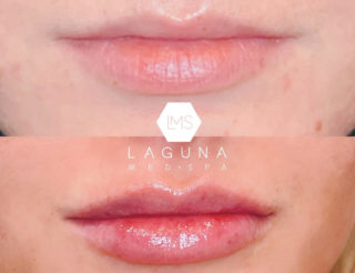 Lipolean Injections - Botox - Juvederm - Restylane | Laguna Med Spa