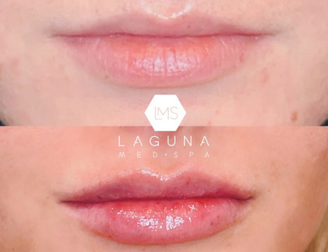 Lipolean Injections - Botox - Juvederm - Restylane | Laguna Med Spa