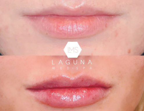 Lipolean Injections - Botox - Juvederm - Restylane | Laguna Med Spa