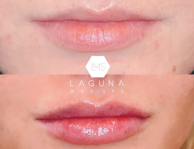 Lipolean Injections - Botox - Juvederm - Restylane | Laguna Med Spa