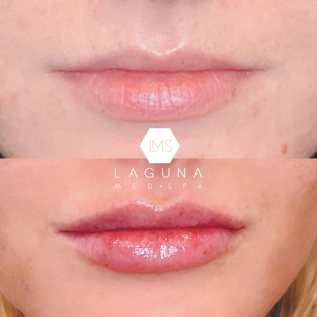 Lipolean Injections - Botox - Juvederm - Restylane | Laguna Med Spa