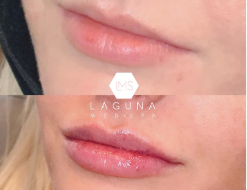 Lipolean Injections - Botox - Juvederm - Restylane | Laguna Med Spa